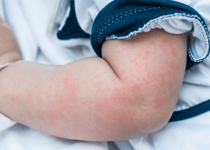 Can Long Covid Cause Hives Skinhealthhubs