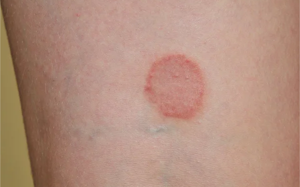 What Are The Healing Stages Of Ringworm - Skinhealthhubs.com